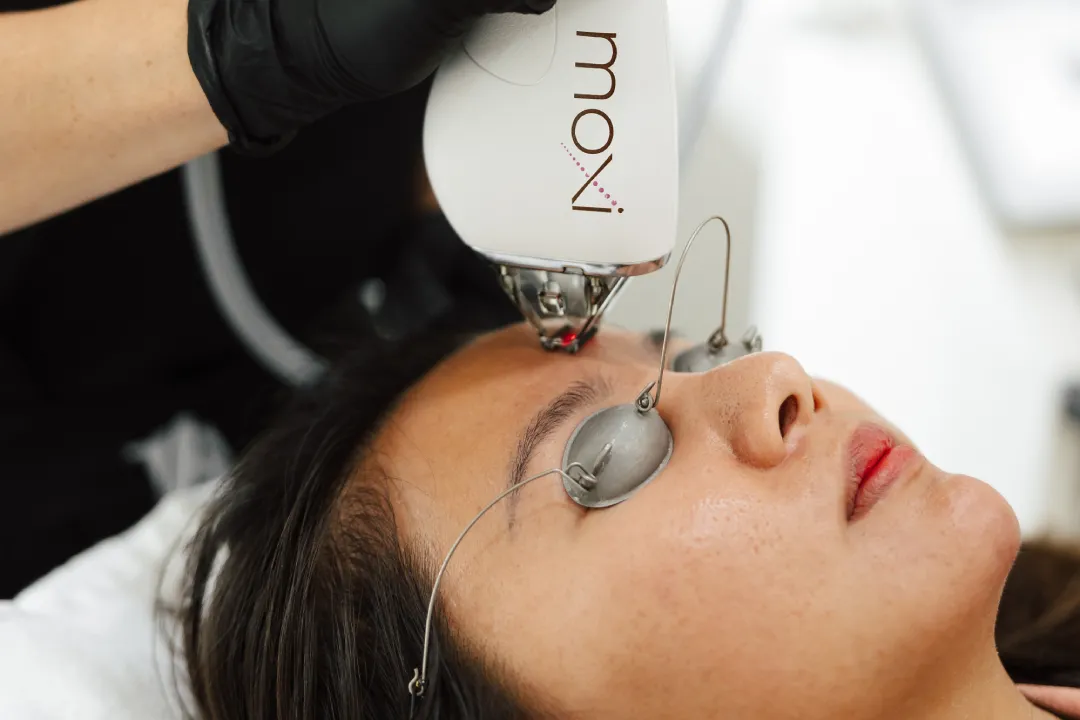 Moxi Treatment In Florence, KY | Laser Face Treatment
