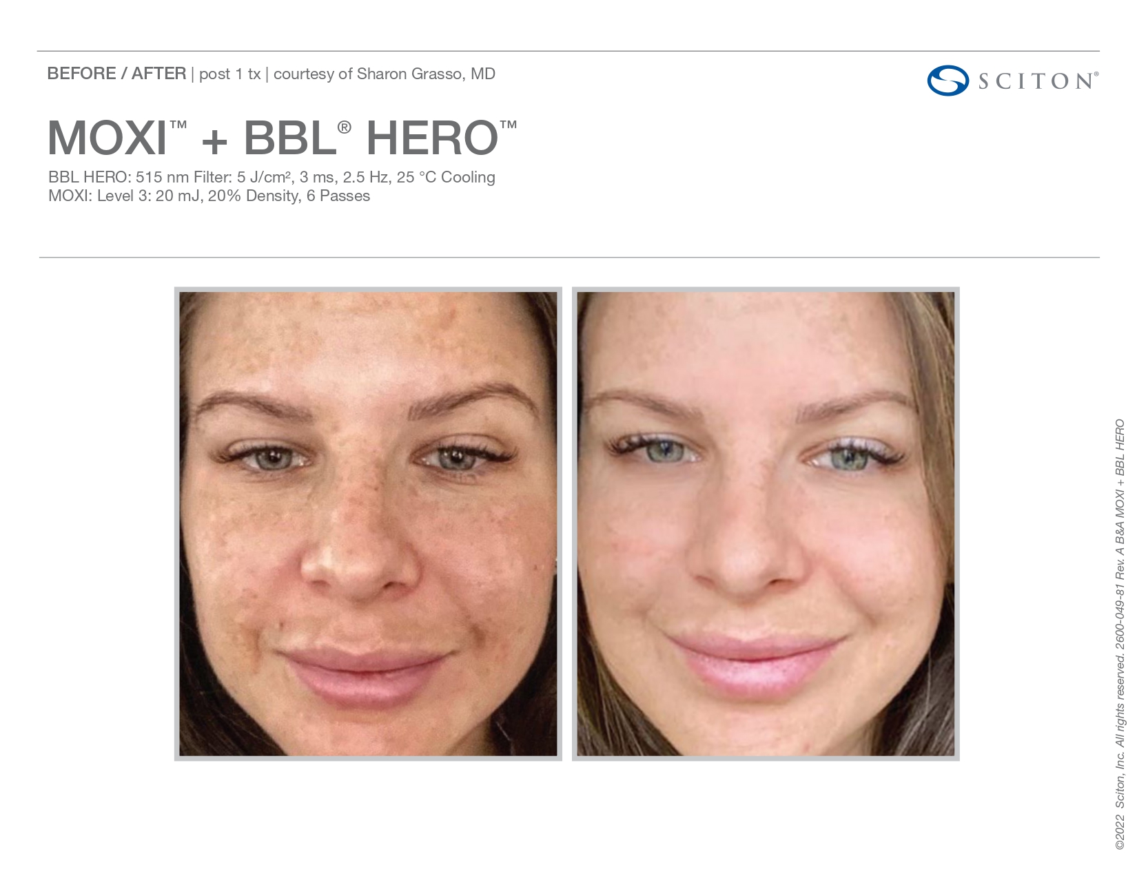 Moxi In Florence KY Skin Rejuvenation Treatment Moxi In Florence KY Skin Rejuvenation Treatment